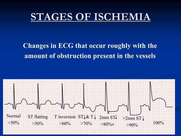 Ecg presentation | PDF
