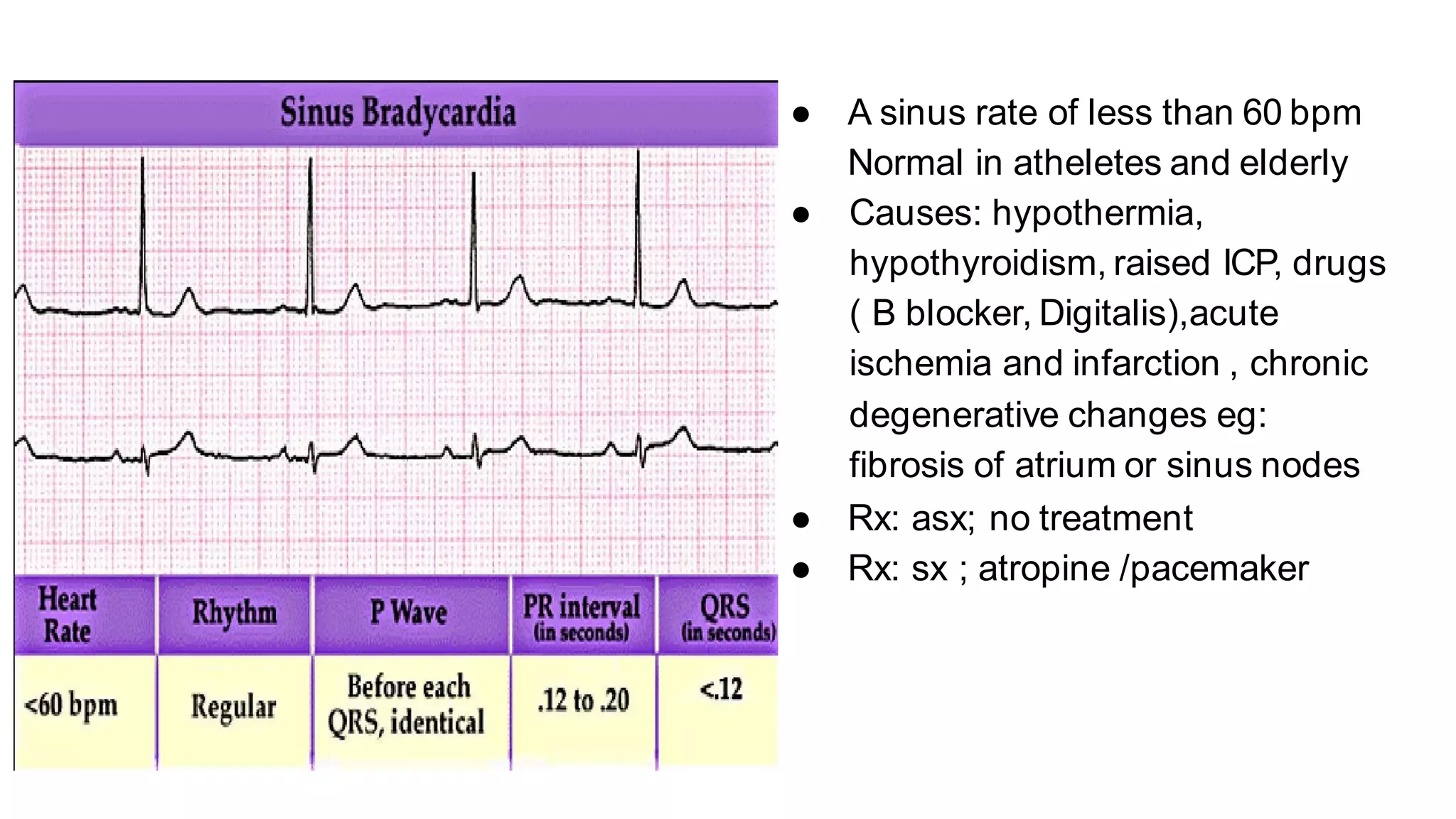 Ecg presentation | PPT