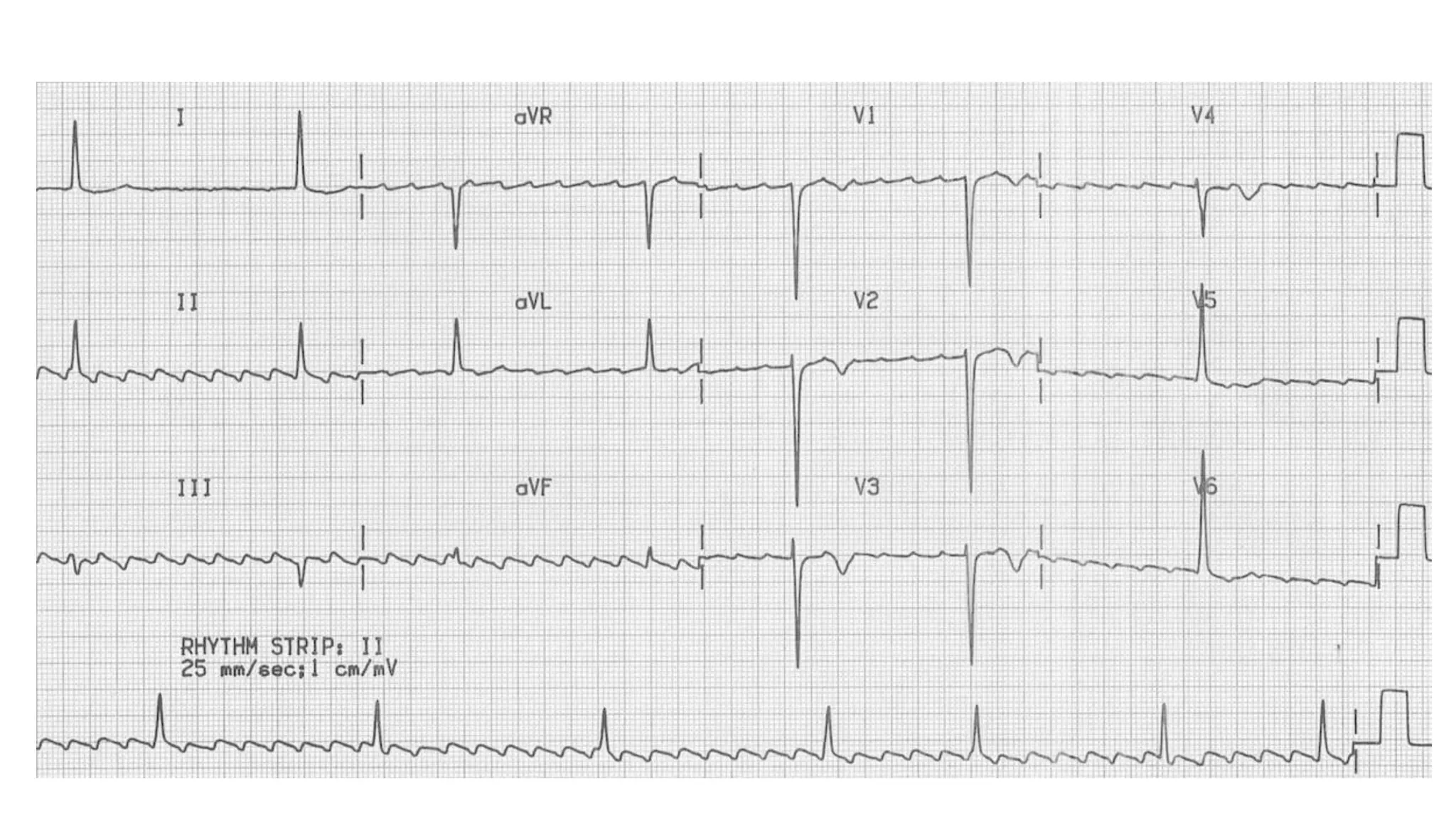 Ecg presentation | PPT