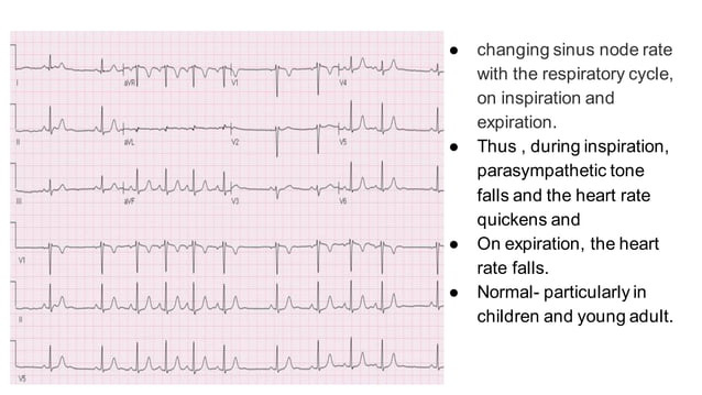 Ecg presentation | PPT
