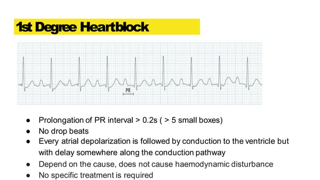 Ecg presentation | PPT