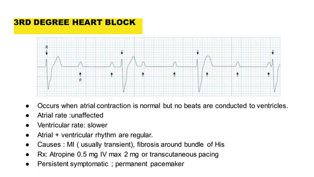 Ecg presentation | PPT