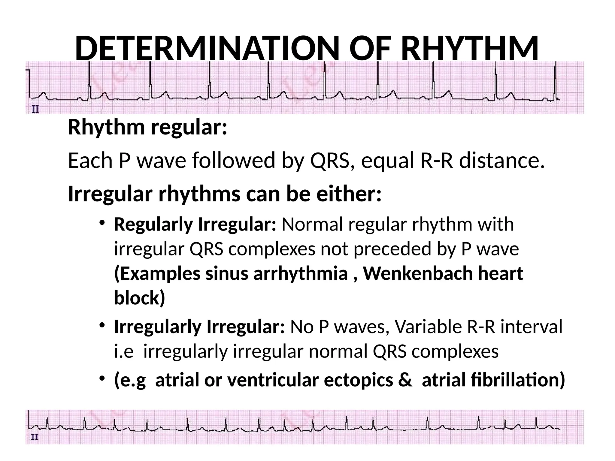 ECG_PRESENTATION by a doctor ecg overview | PPT