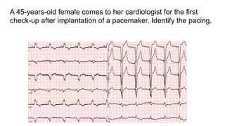 ELECTROCARDIOGRAPHY EXAMPLE questions.pptx