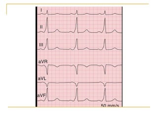 PowerPoint presentation of ECG Quick Reference.PPT