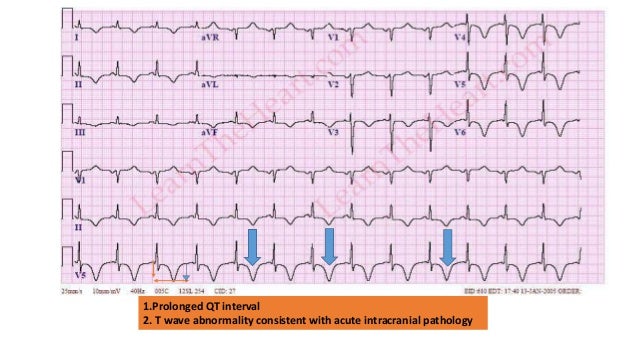 Ecg quiz