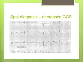 Ecg quiz | PPTX
