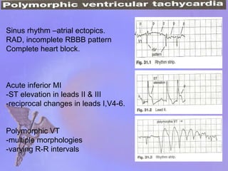 ECG: Quiz | PPT