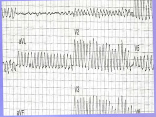 ECG: Quiz | PPT