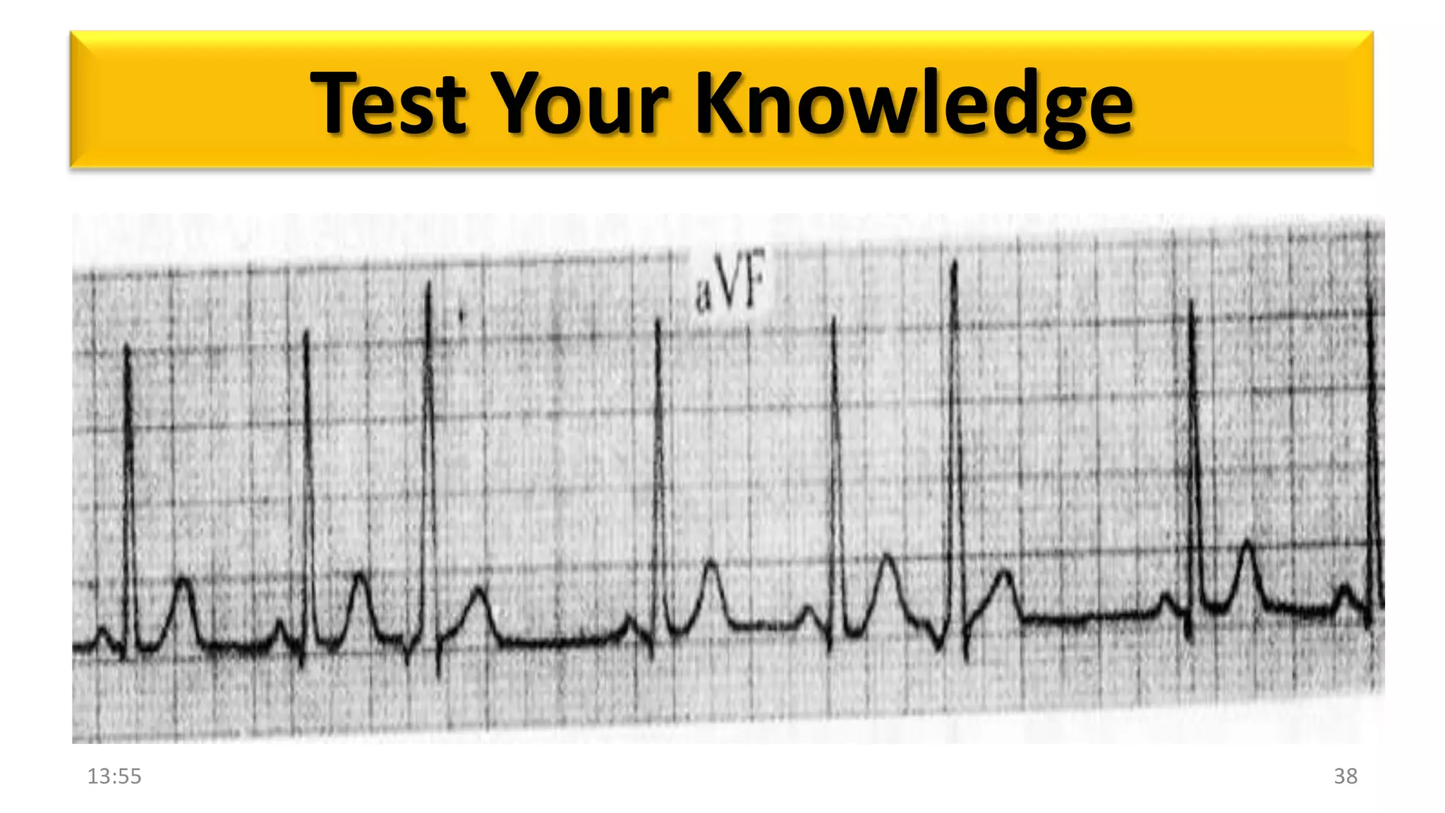 Ecg reading | PPTX
