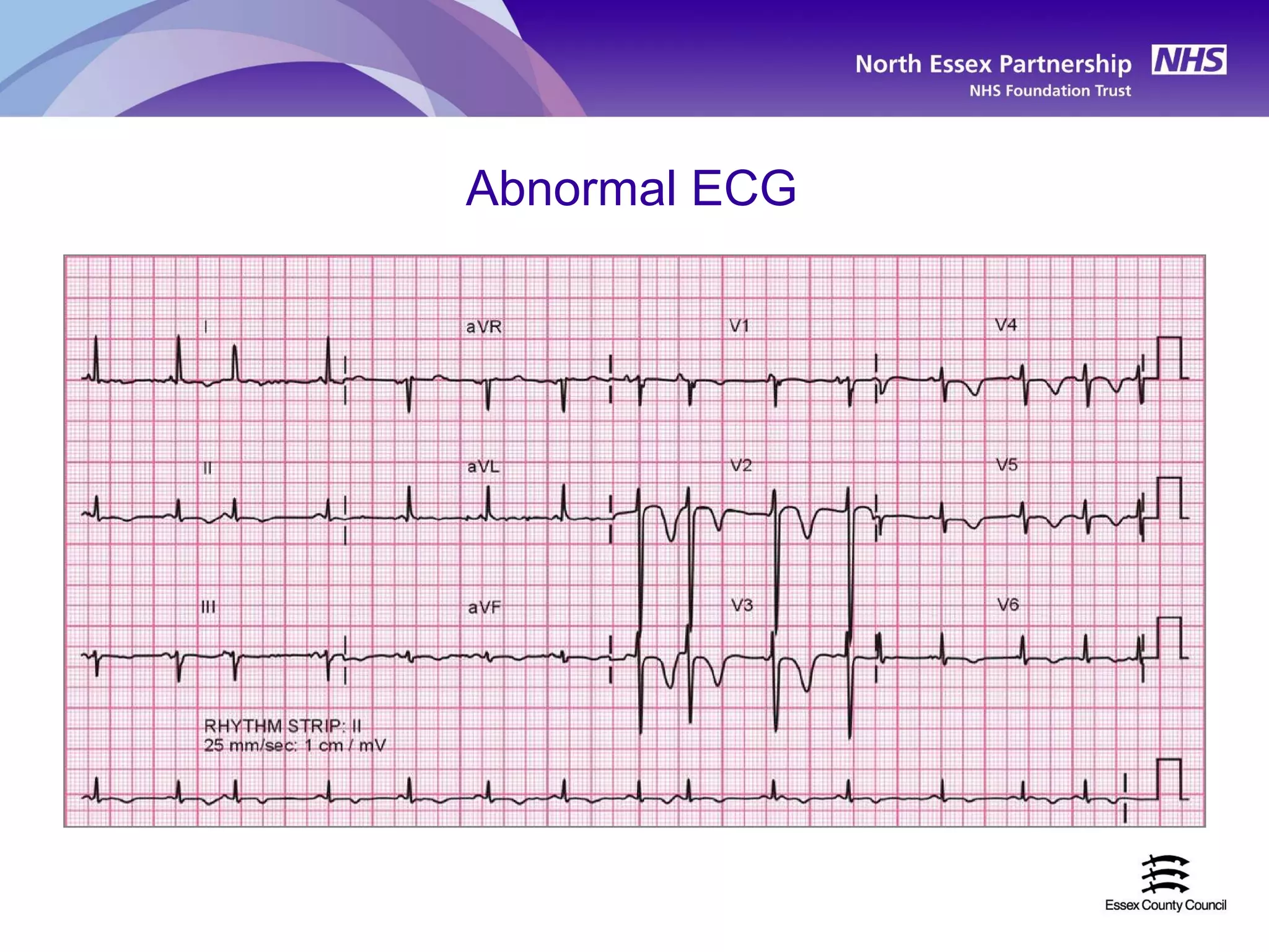 Ecg recording basic interpretation e learning 2 | PPT | Heart and ...