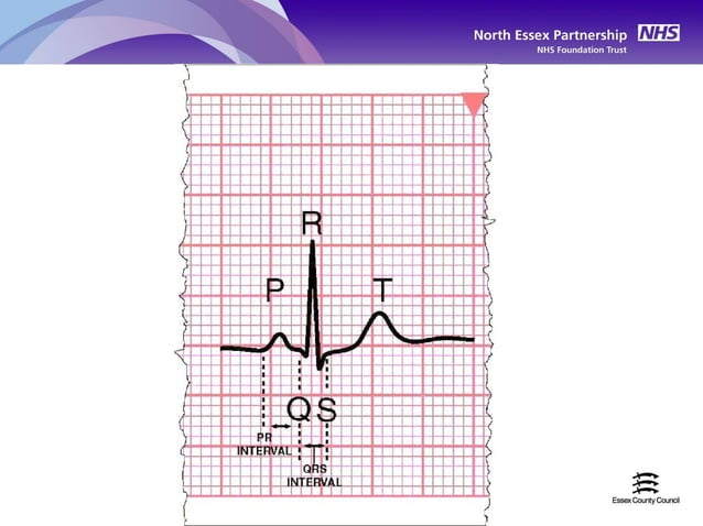 Ecg recording basic interpretation e learning 2 | PPT | Heart and ...