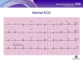 Ecg recording basic interpretation e learning 2 | PPT