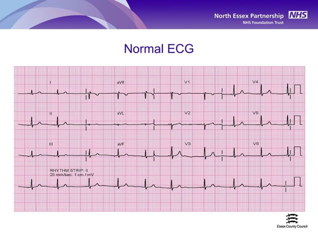 Ecg recording basic interpretation e learning 2 | PPT | Heart and ...