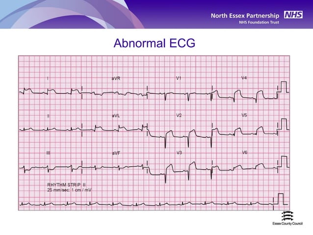 Ecg recording basic interpretation e learning 2 | PPT | Heart and ...