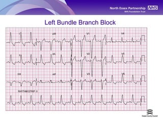Ecg recording basic interpretation e learning 2 | PPT | Heart and Cardiovascular Diseases ...