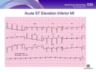 Ecg recording basic interpretation e learning 2 | PPT | Heart and Cardiovascular Diseases ...