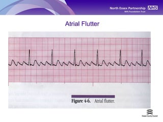 Ecg recording basic interpretation e learning 2 | PPT | Heart and ...