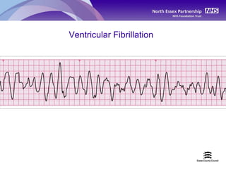 Ecg recording basic interpretation e learning 2 | PPT | Heart and Cardiovascular Diseases ...