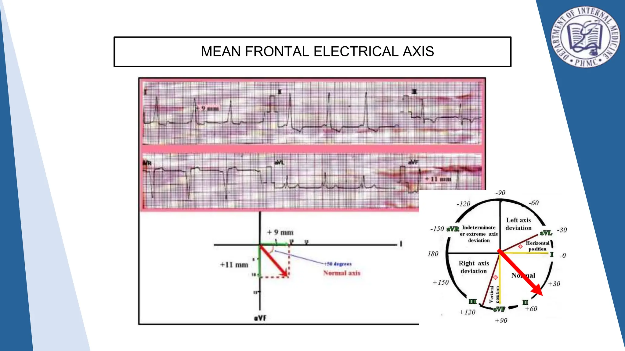 Ecg report normal sinus rhythm with variants of qrs complex.pptx