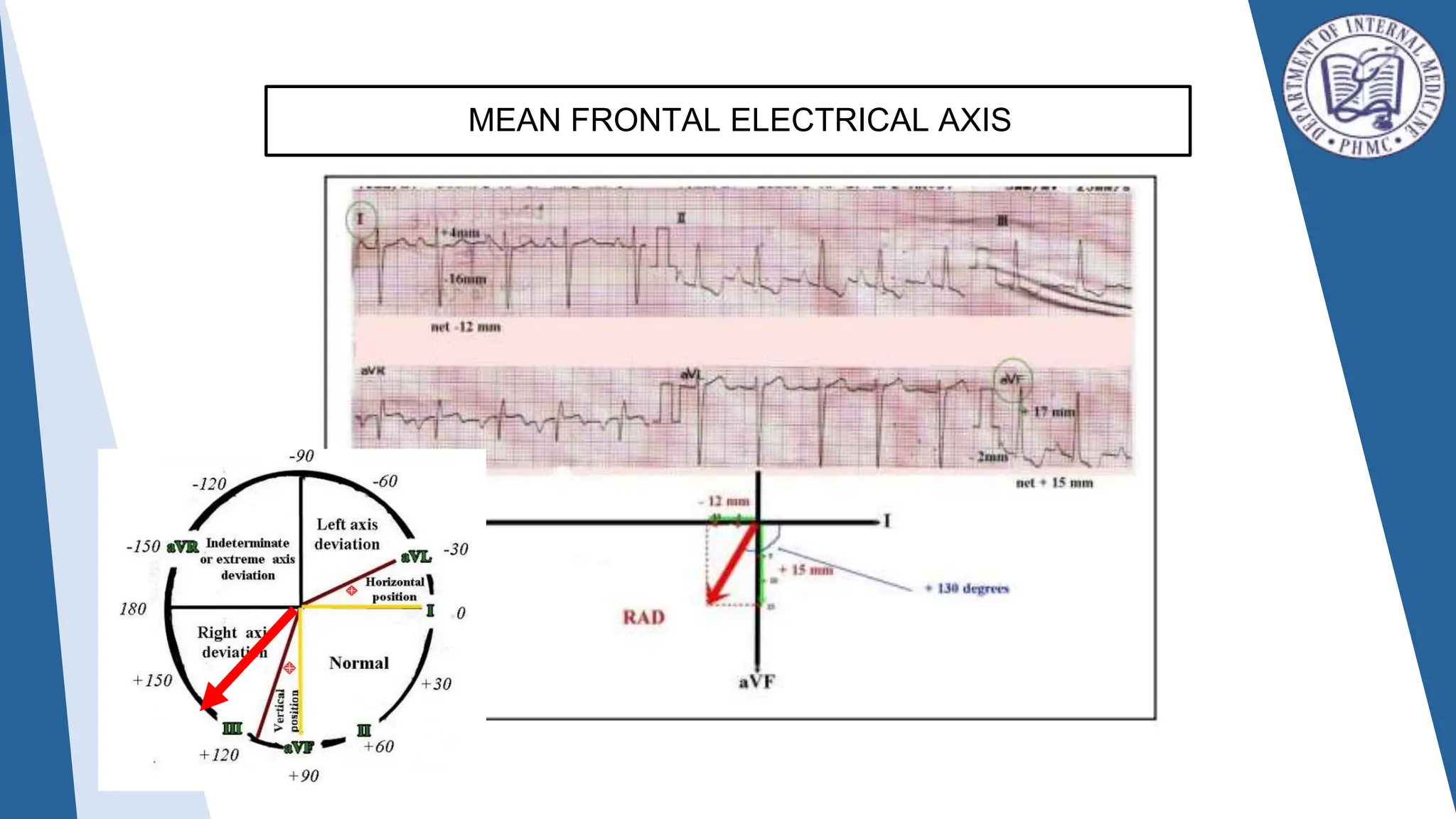 Ecg report normal sinus rhythm with variants of qrs complex.pptx