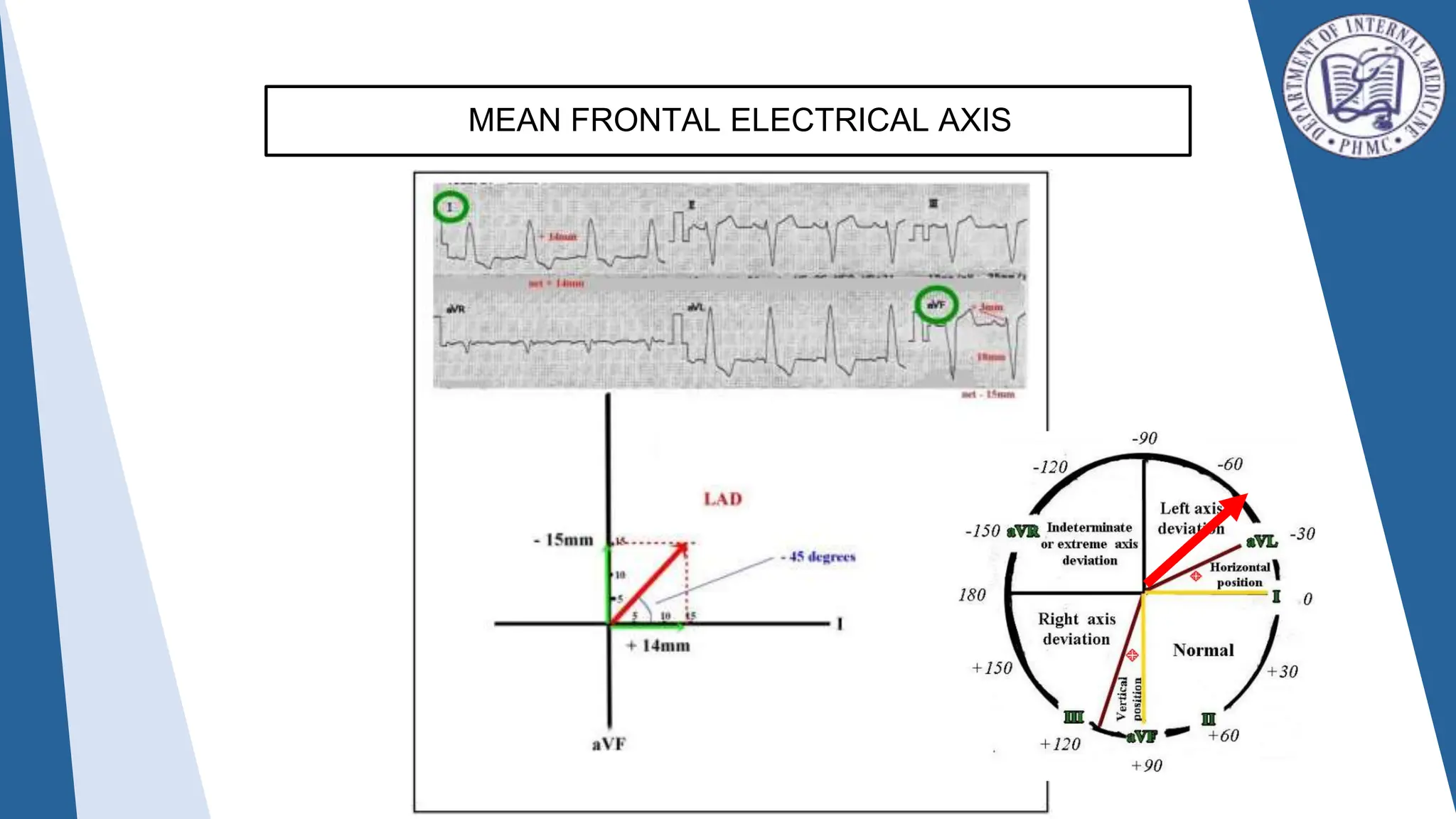 Ecg report normal sinus rhythm with variants of qrs complex.pptx