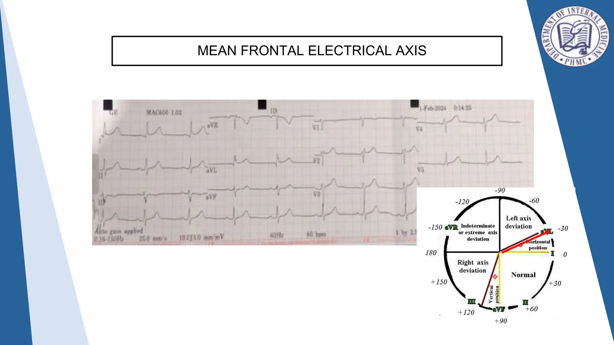 Ecg report normal sinus rhythm with variants of qrs complex.pptx
