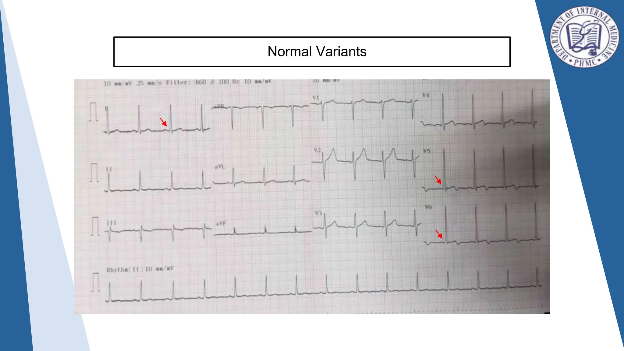 Ecg report normal sinus rhythm with variants of qrs complex.pptx