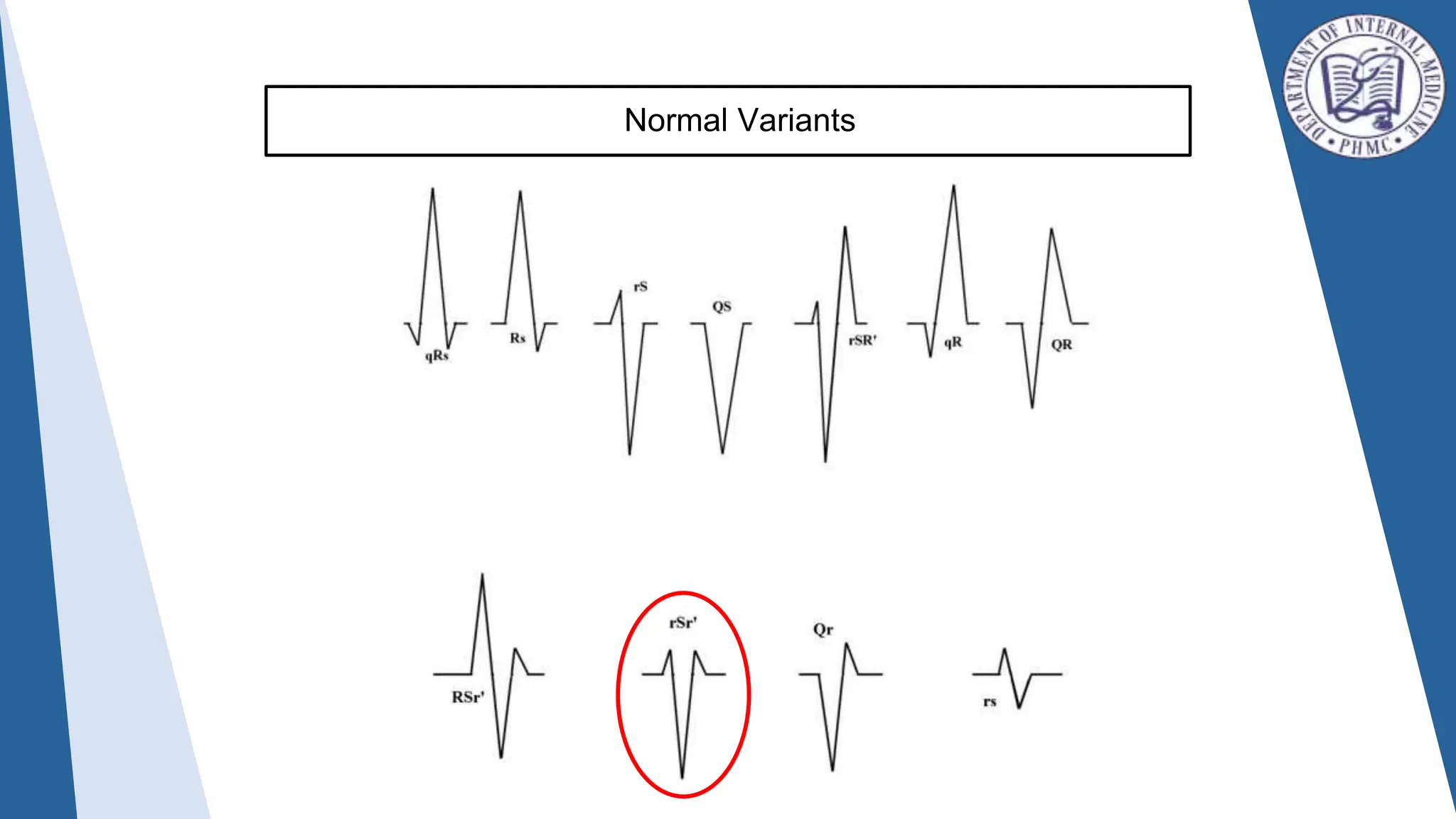 Ecg report normal sinus rhythm with variants of qrs complex.pptx