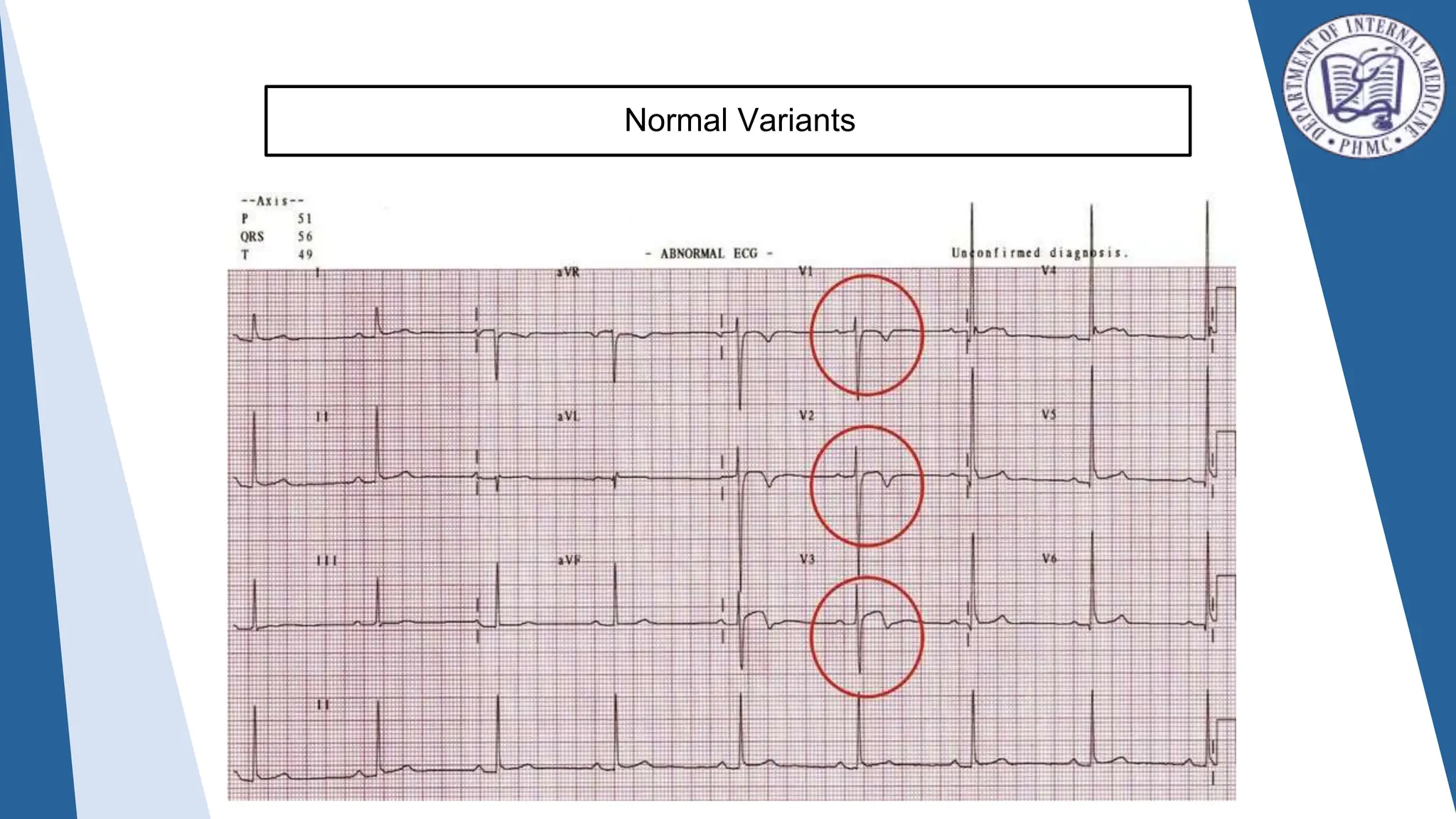 Ecg report normal sinus rhythm with variants of qrs complex.pptx