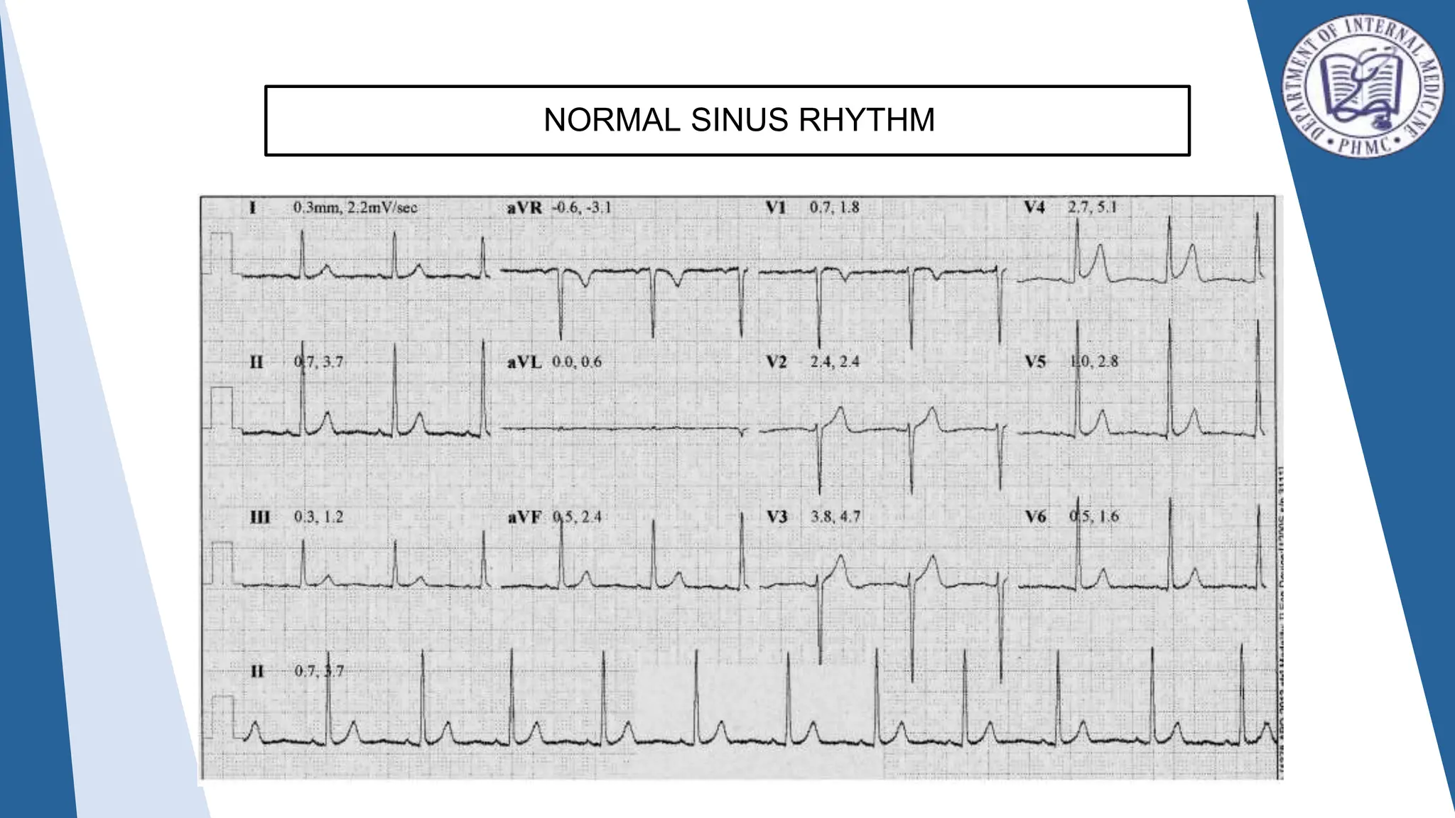 Ecg report normal sinus rhythm with variants of qrs complex.pptx