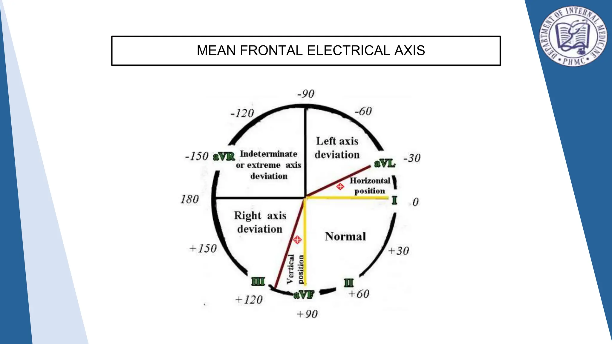 Ecg report normal sinus rhythm with variants of qrs complex.pptx