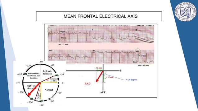 Ecg report normal sinus rhythm with variants of qrs complex.pptx