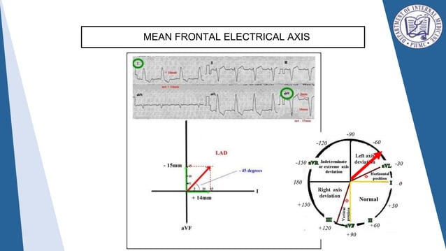 Ecg report normal sinus rhythm with variants of qrs complex.pptx