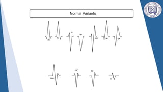 Ecg report normal sinus rhythm with variants of qrs complex.pptx