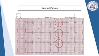 Ecg report normal sinus rhythm with variants of qrs complex.pptx