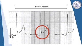 Ecg report normal sinus rhythm with variants of qrs complex.pptx