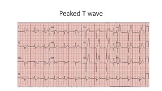 Cardiac Tamponade Ecg Strip