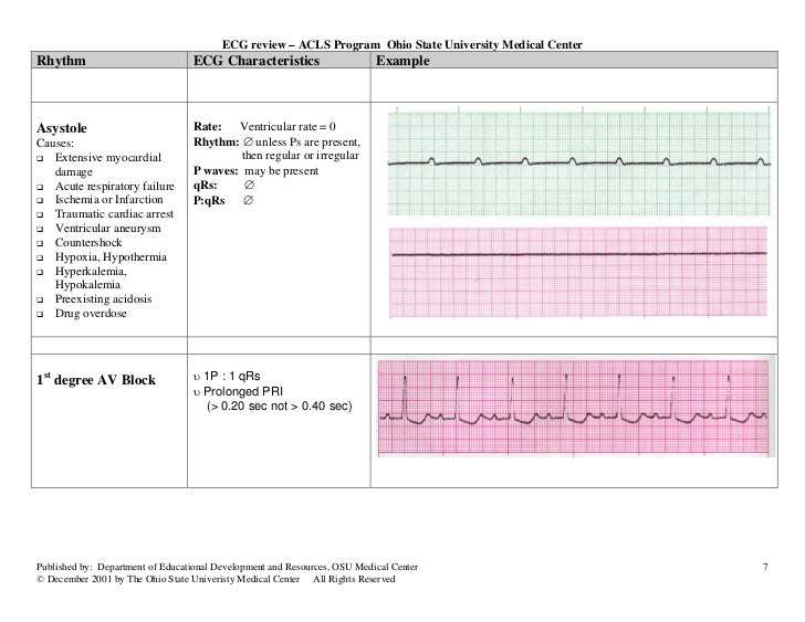 Ecg Interpretation Ecg Interpretation Review 69 Pvc