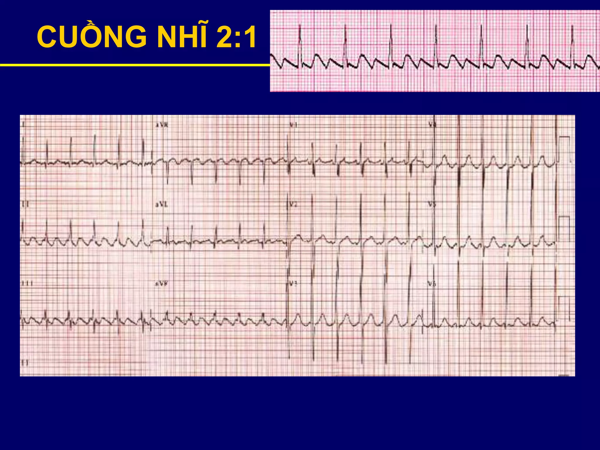 ECG RỐI LOẠN NHỊP | PPTX