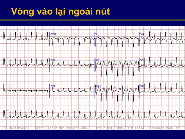 ECG RỐI LOẠN NHỊP | PPTX
