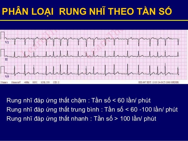 ECG RỐI LOẠN NHỊP