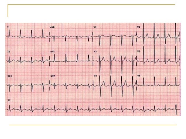 ECG Interpretation