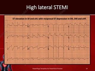 ECG S | PPT