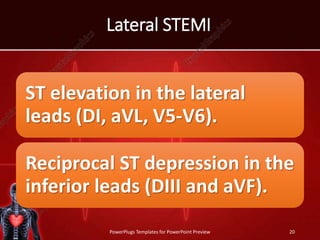 ECG S | PPT