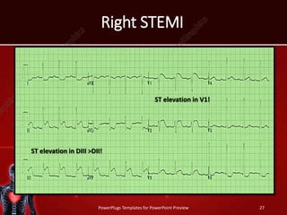ECG S | PPT