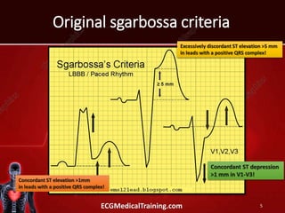 ECG S | PPT