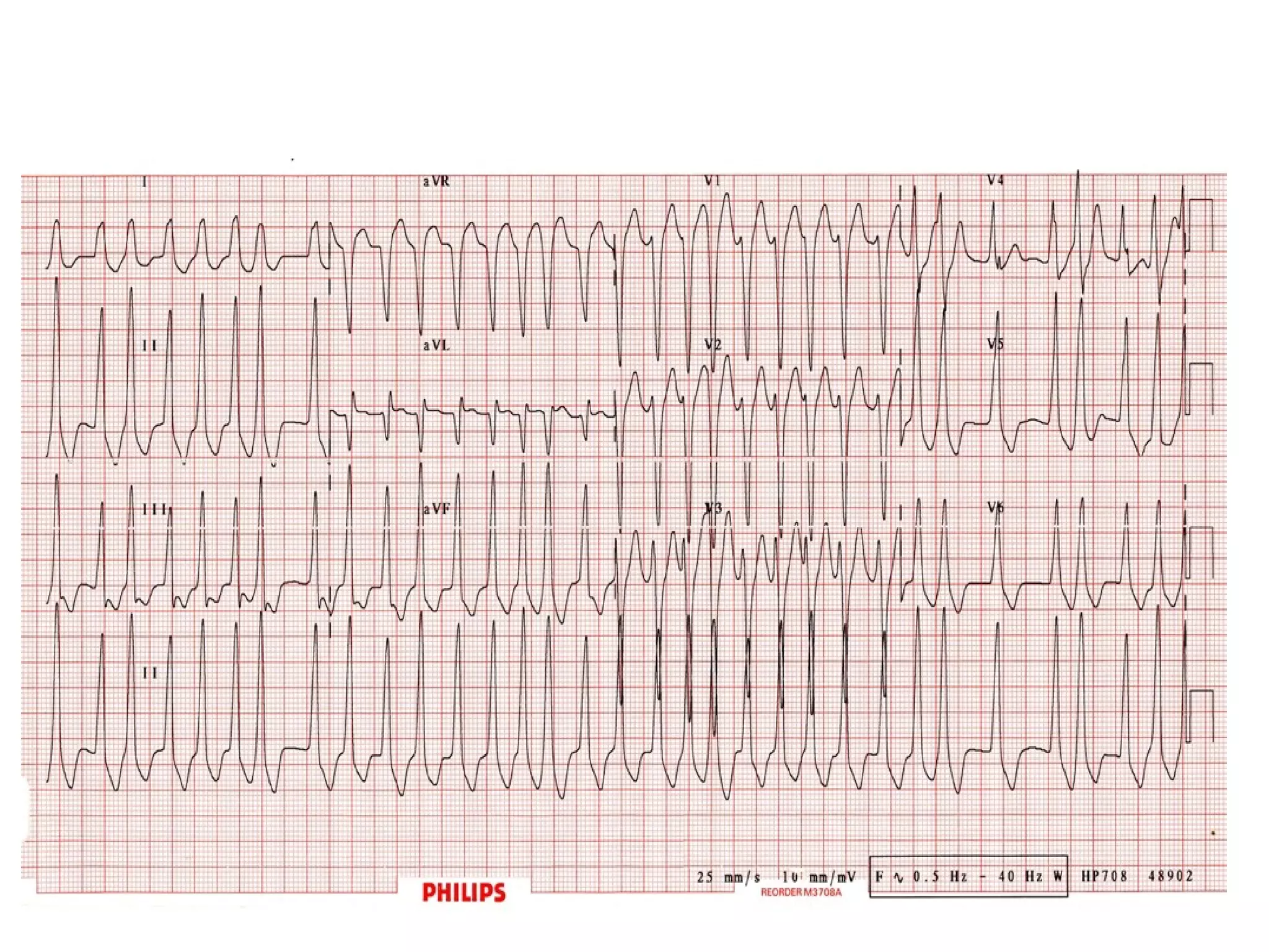 ECG markers in Sudden Cardiac Death | PPT