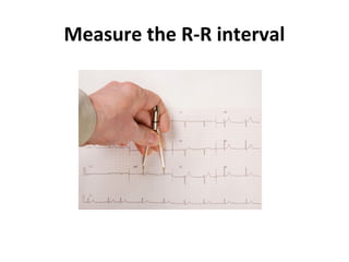 ECG markers in Sudden Cardiac Death | PPT