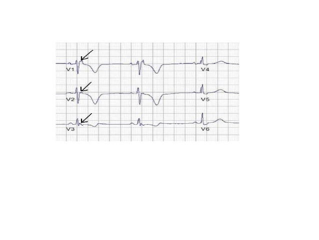 ECG markers in Sudden Cardiac Death
